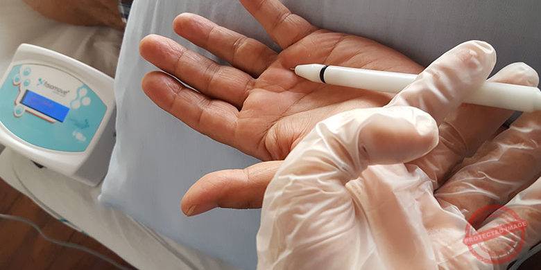 Dedo en Gatillo o en Resorte - Elisa Moreno